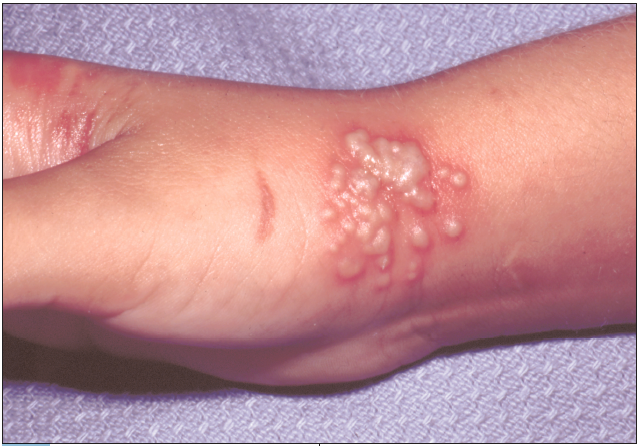 Herpes Simplex Skin Rash
